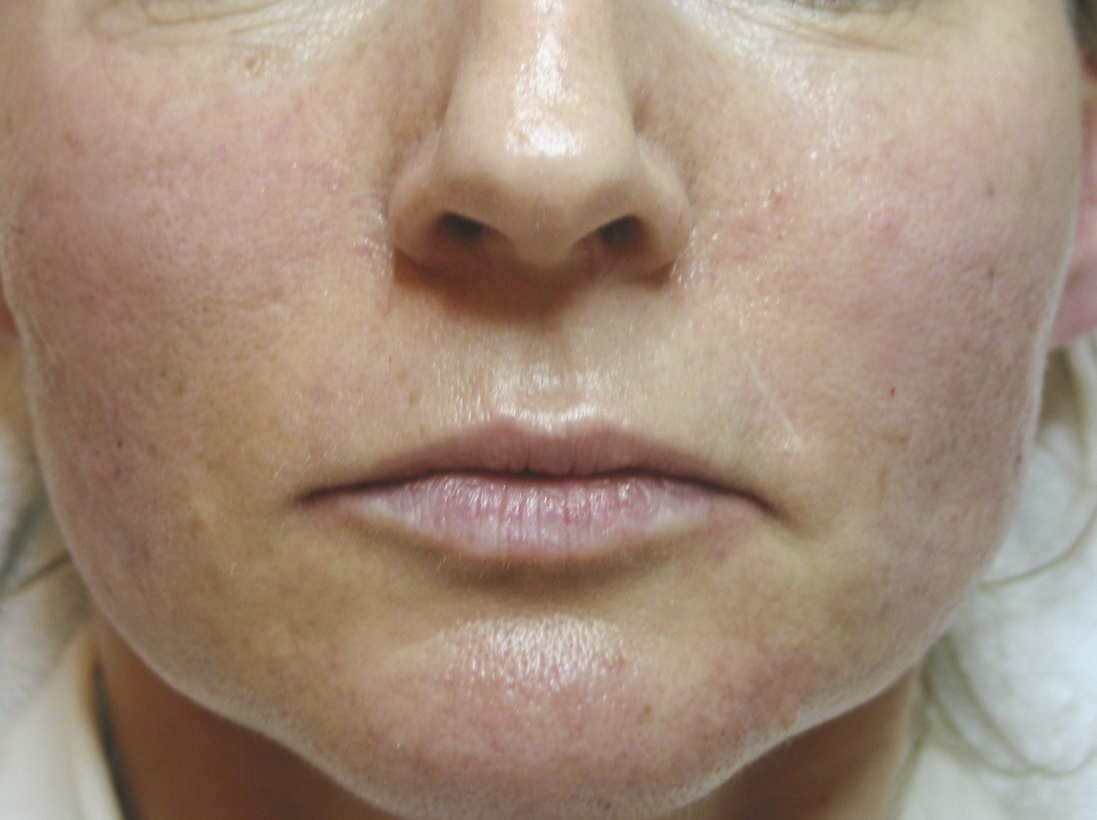 (Acne) Littekens in uw gezicht verwijderen met Hyaluronzuur