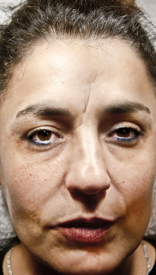 (Acne) Littekens in uw gezicht verwijderen met Hyaluronzuur