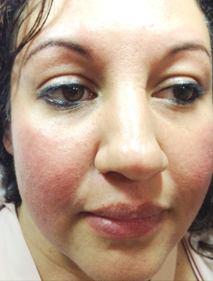 (Acne) Littekens in uw gezicht verwijderen met Hyaluronzuur