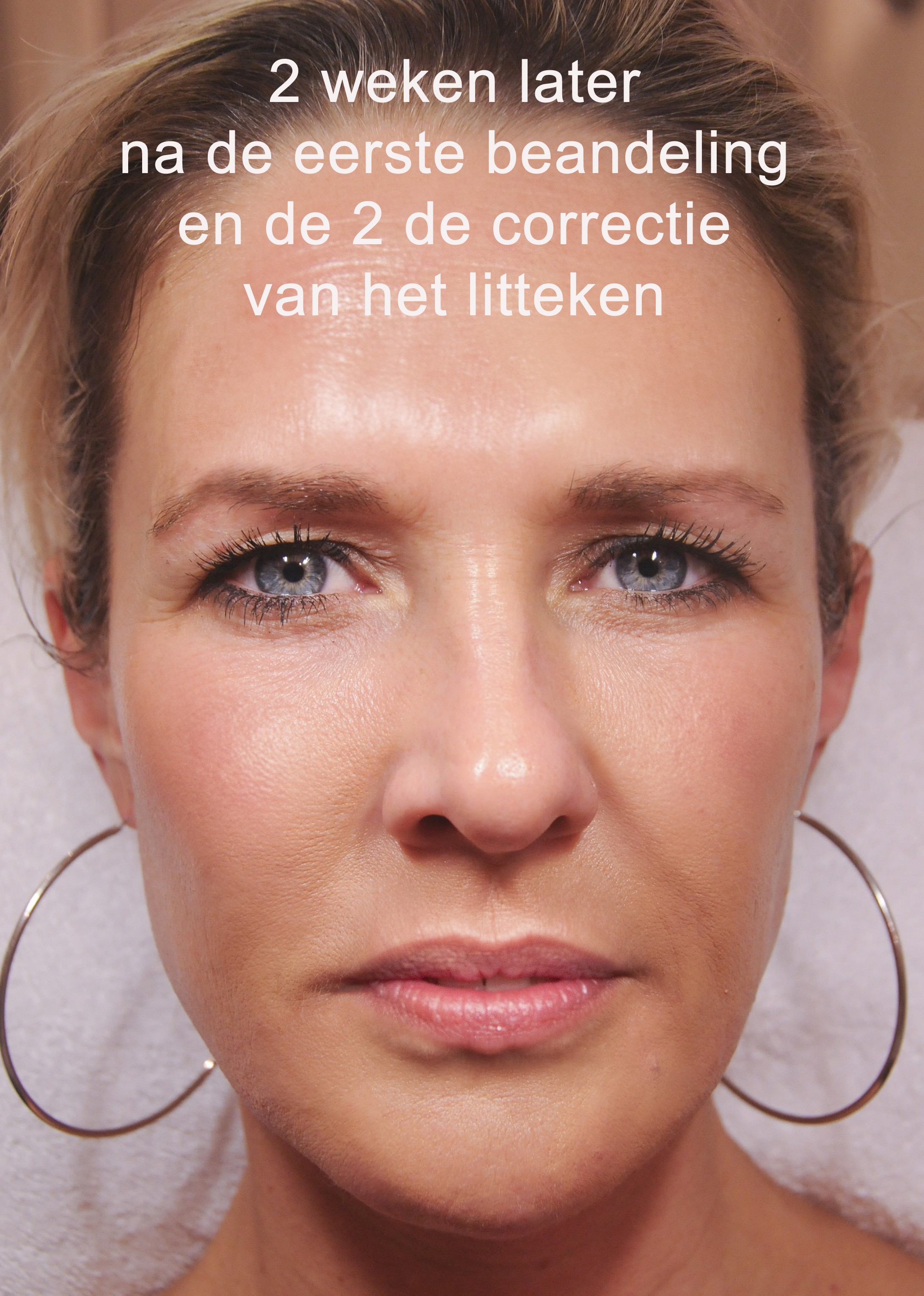 (Acne) Littekens in uw gezicht verwijderen met Hyaluronzuur