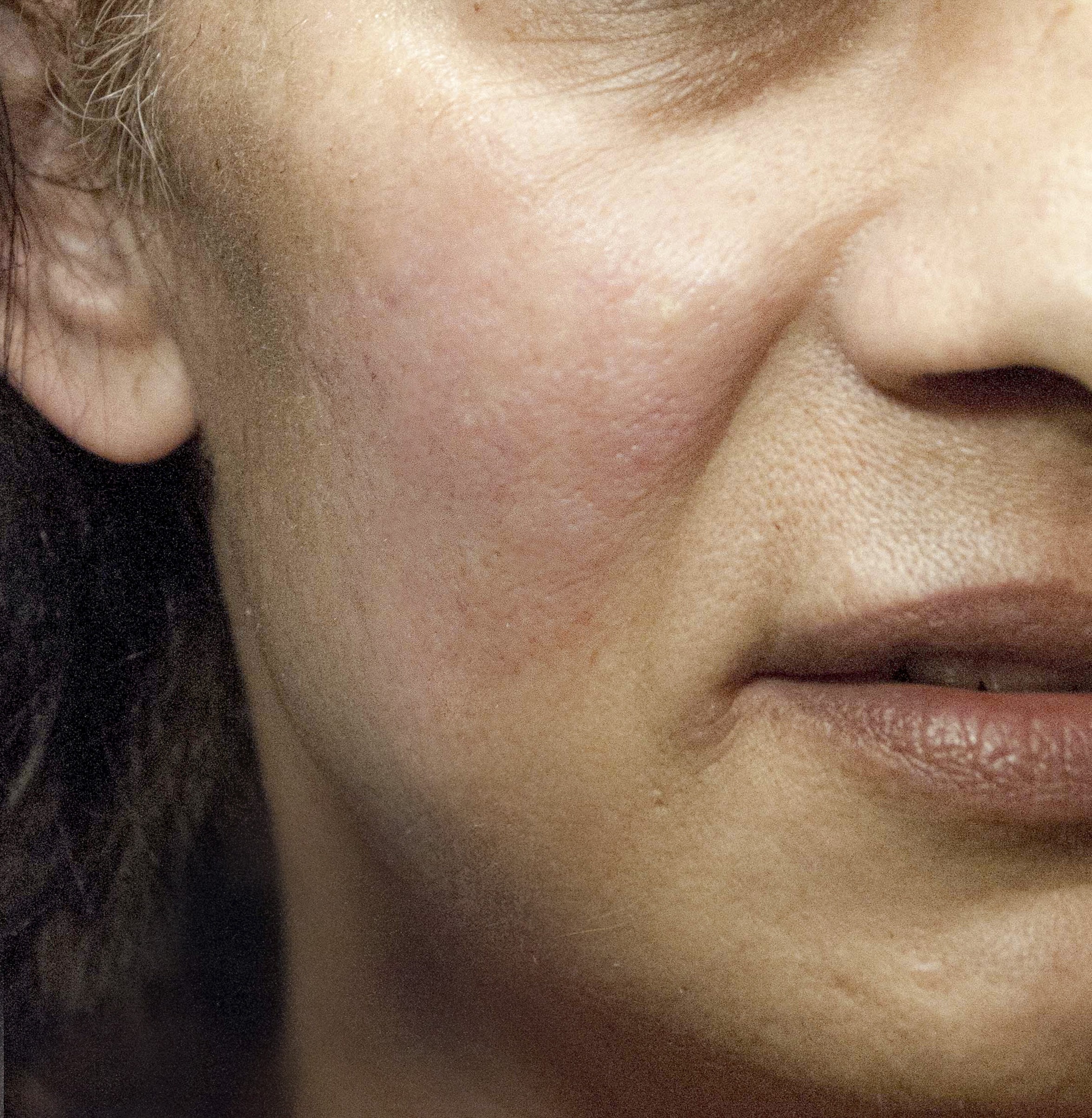 (Acne) Littekens in uw gezicht verwijderen met Hyaluronzuur